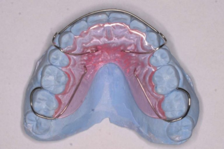 保定装置（リテーナー）の種類についてのご質問 | アクイユ矯正歯科クリニック