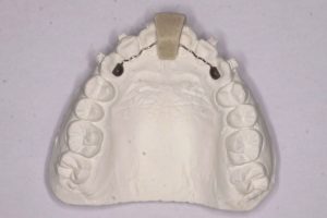 保定装置（リテーナー）の種類についてのご質問｜アクイユ矯正歯科クリニック（所沢市）｜埼玉県新所沢駅の矯正歯科医院